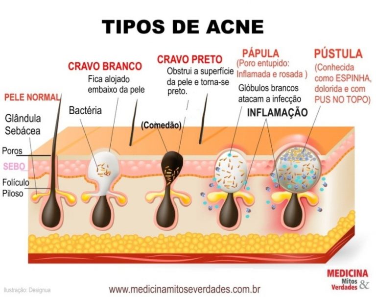 Tratamento de Acne – Toque Especial Estética